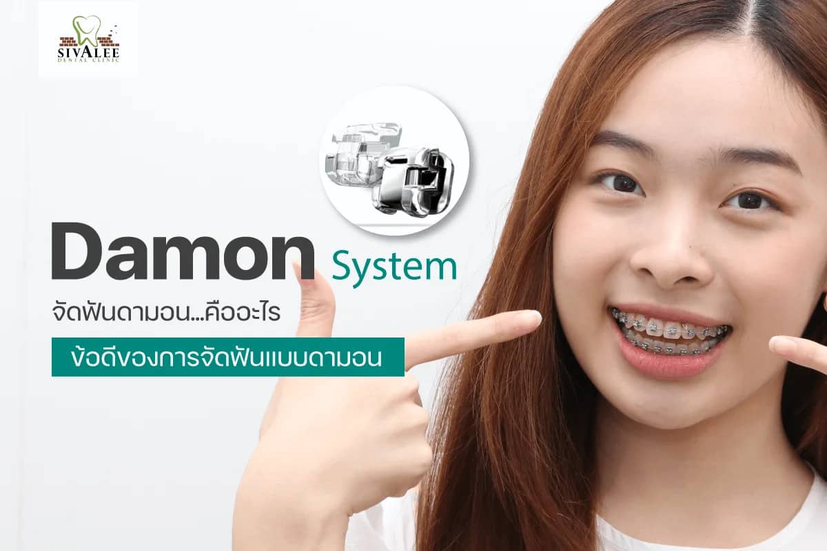 จัดฟันแบบดามอน (Damon System) คืออะไร เหมาะกับใคร รีวิว โดยทันตแพทย์
