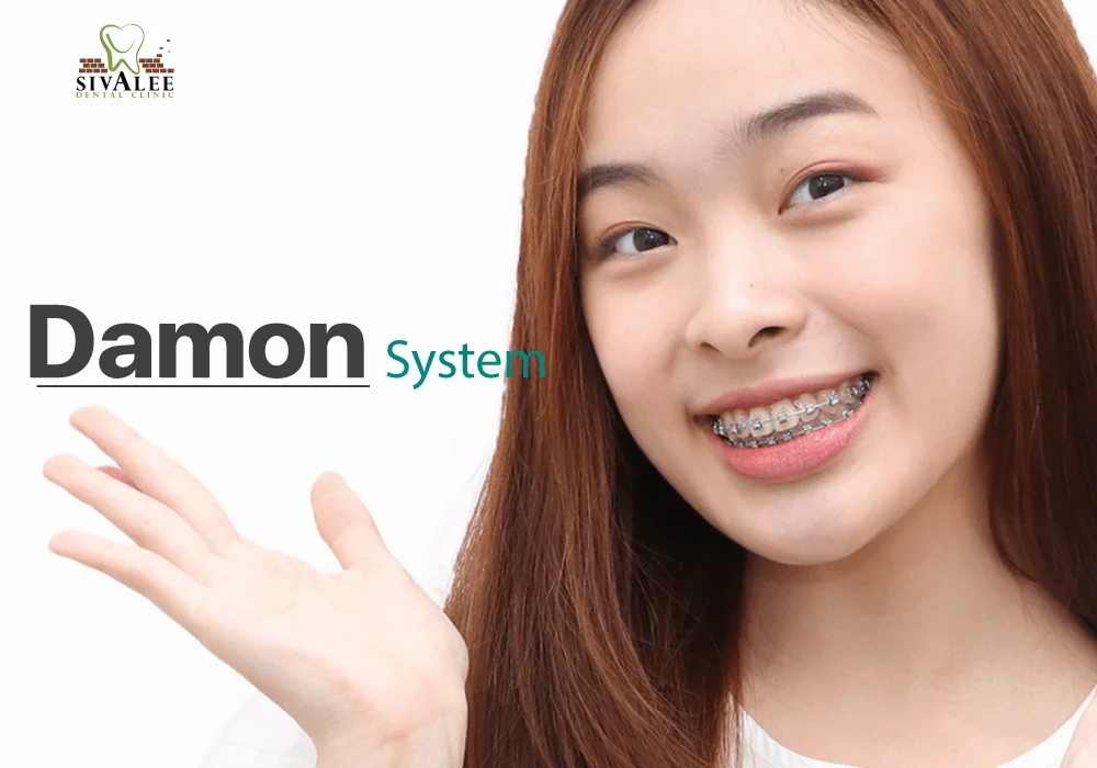 จัดฟันแบบดามอน (Damon System) คืออะไร เหมาะกับใคร รีวิว โดยทันตแพทย์