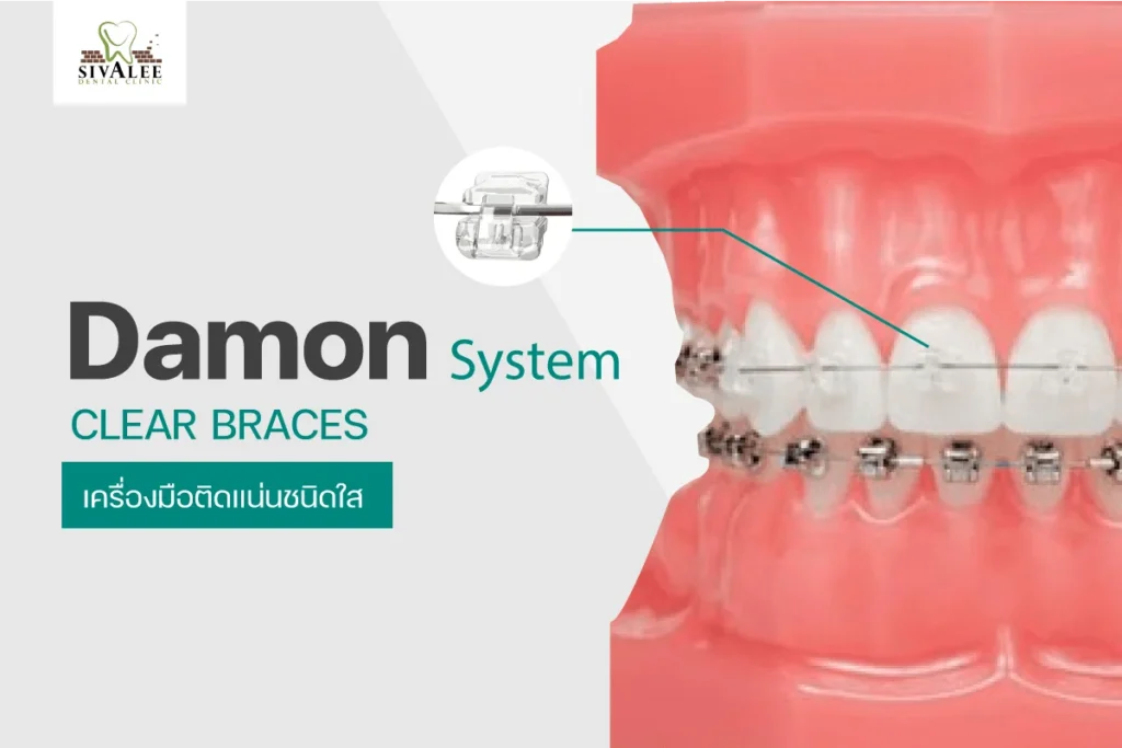 จัดฟันแบบดามอน (Damon System) คืออะไร เหมาะกับใคร รีวิว โดยทันตแพทย์